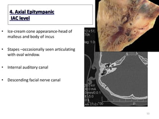 Temporal bone radiology | PPTX