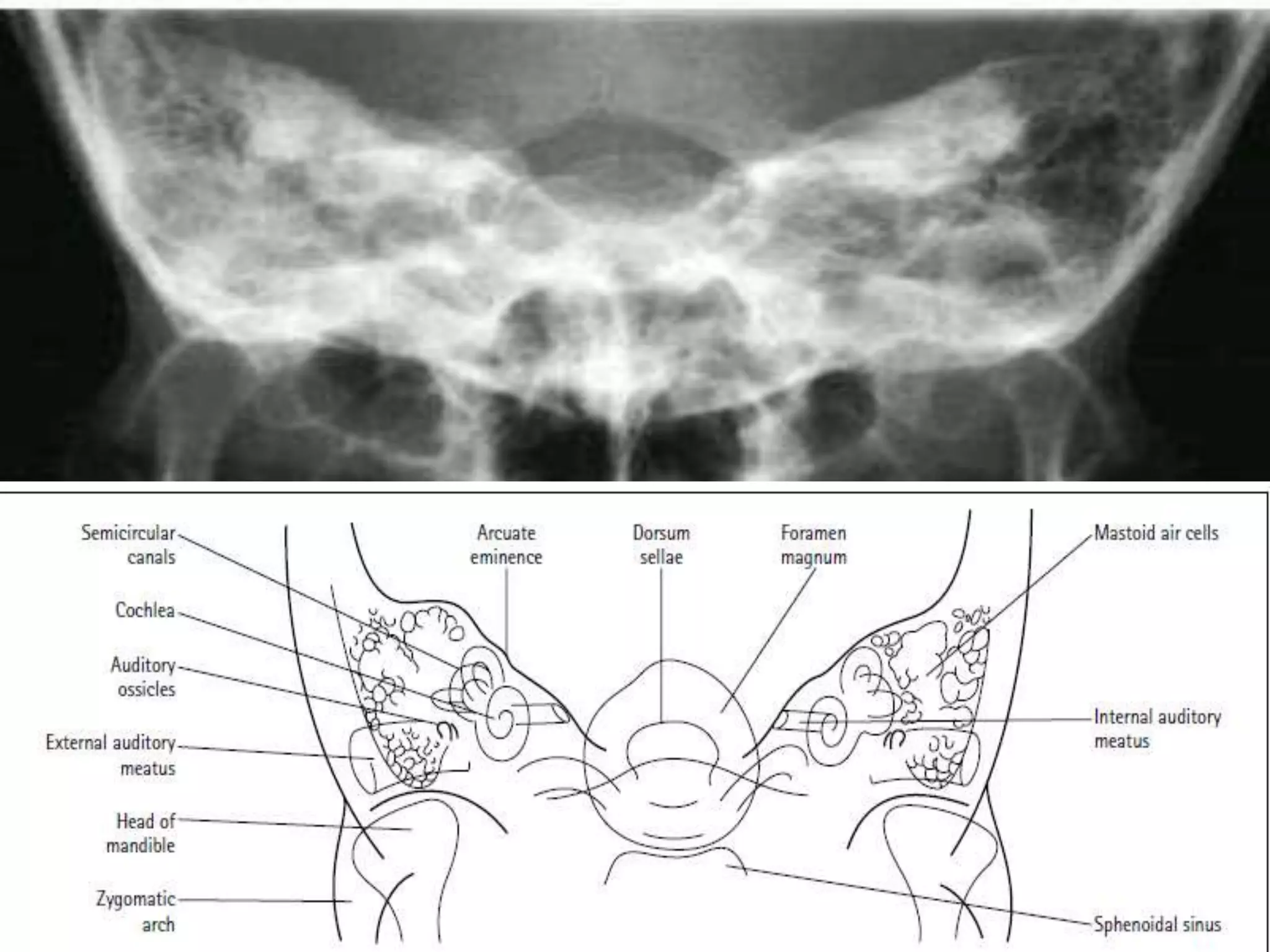 IMAGING OF TEMPORAL BONE | PPTX