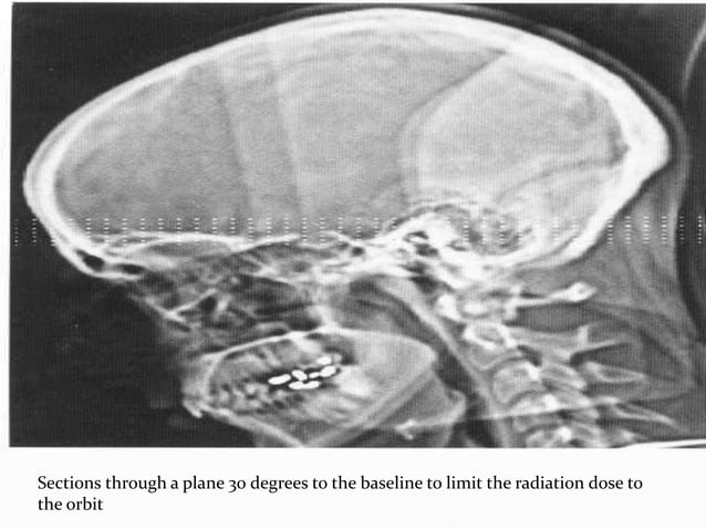 IMAGING OF TEMPORAL BONE | PPTX