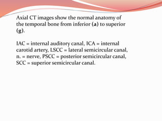 IMAGING OF TEMPORAL BONE | PPTX
