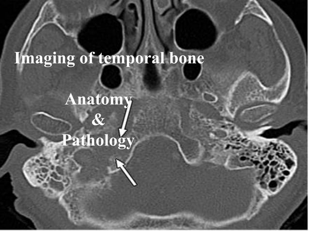 IMAGING OF TEMPORAL BONE