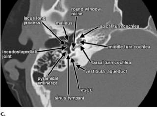 Pyramidal Eminence Ct