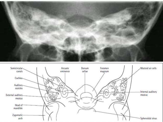 IMAGING OF TEMPORAL BONE