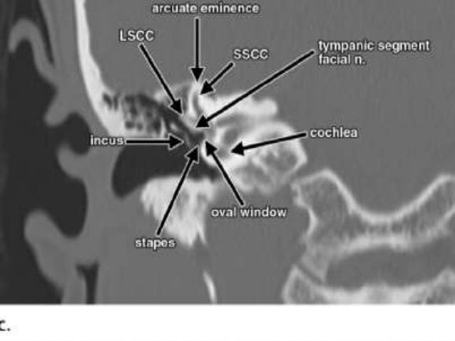 IMAGING OF TEMPORAL BONE