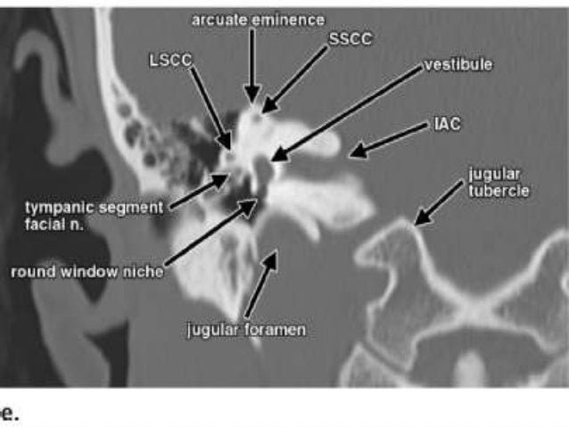 IMAGING OF TEMPORAL BONE