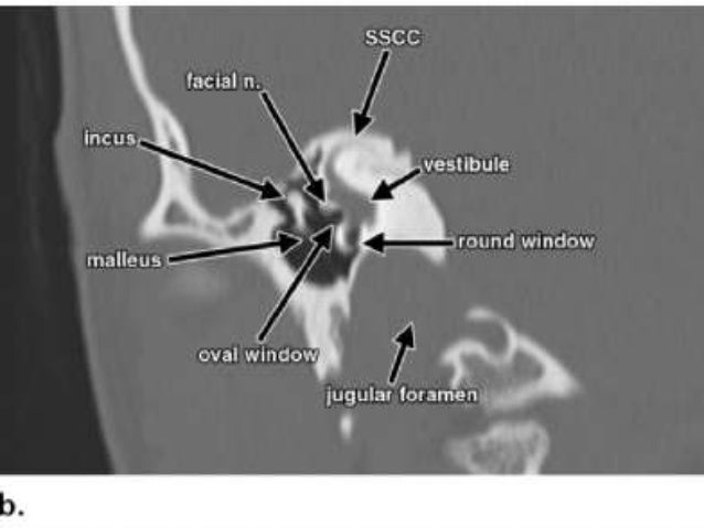 IMAGING OF TEMPORAL BONE