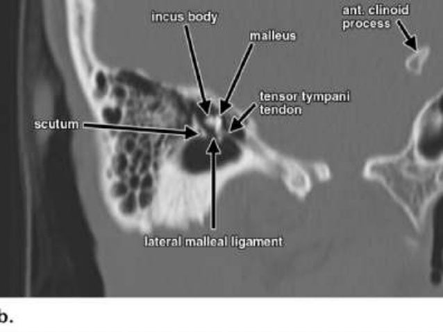 IMAGING OF TEMPORAL BONE