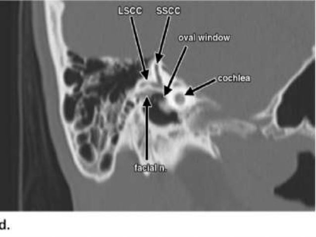 IMAGING OF TEMPORAL BONE