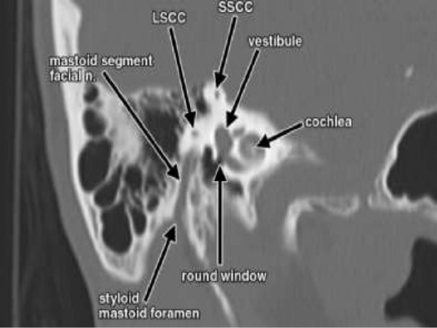 IMAGING OF TEMPORAL BONE