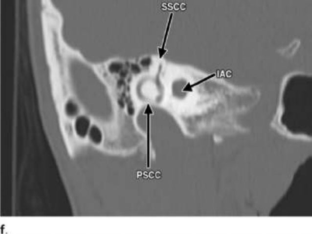 IMAGING OF TEMPORAL BONE