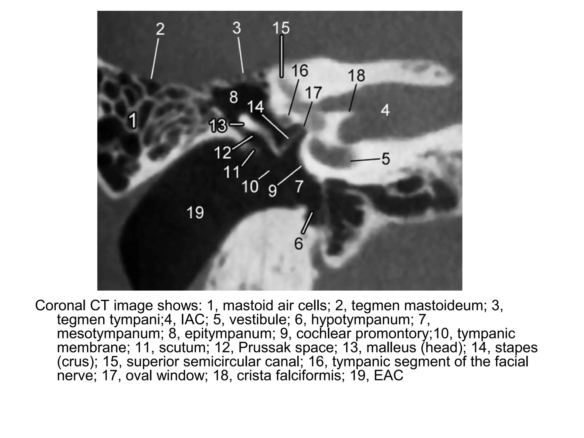 Diagnostic Imaging of Temporal bone | PPT