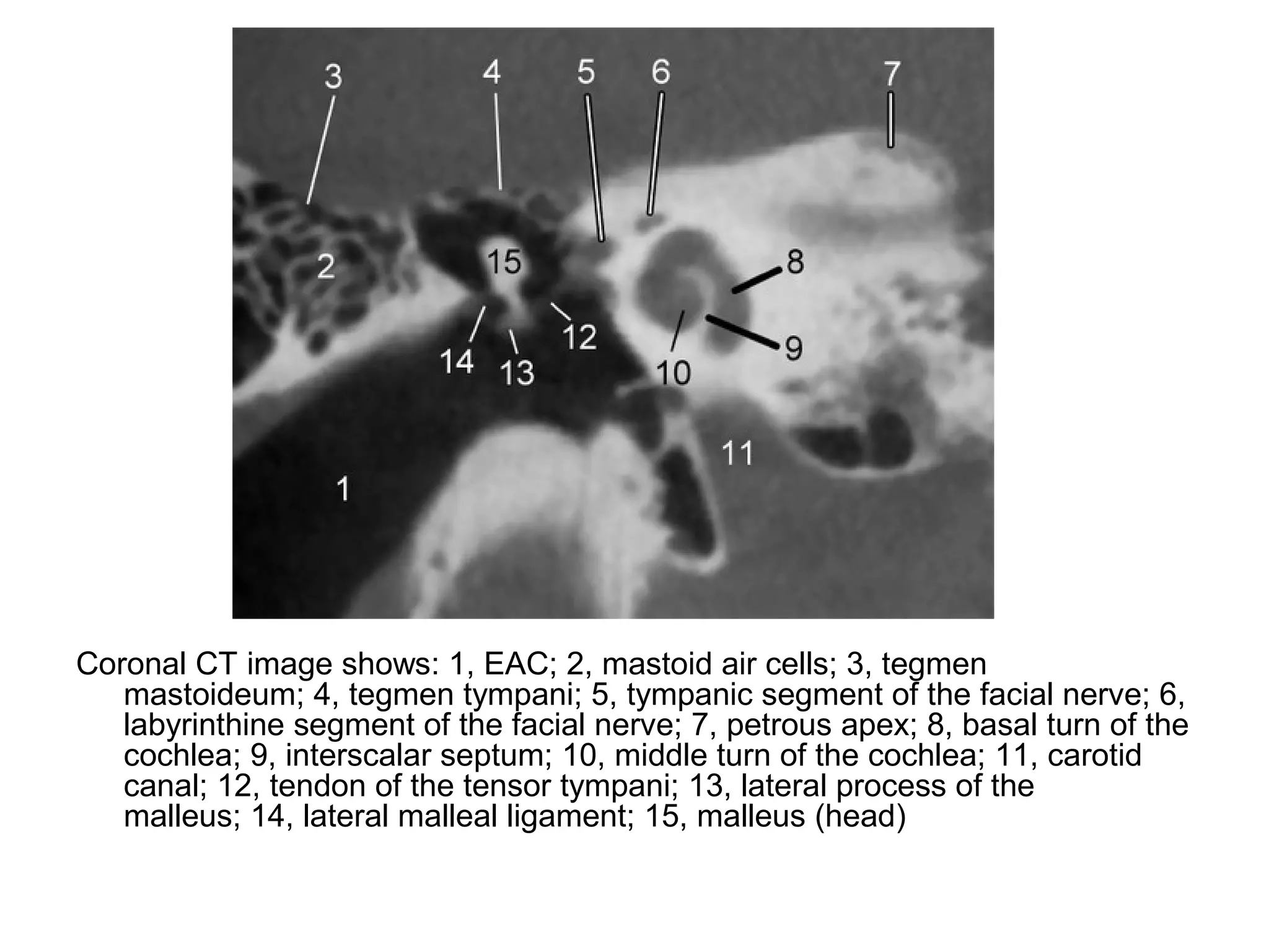 Diagnostic Imaging of Temporal bone | PPT