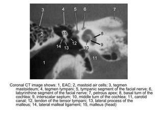 Diagnostic Imaging of Temporal bone | PPT