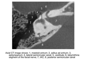Diagnostic Imaging of Temporal bone | PPT