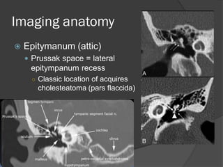Prussak Space Ct Scan