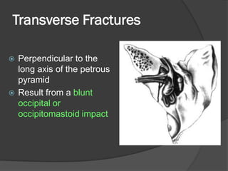 Fracture Petrous Pyramid