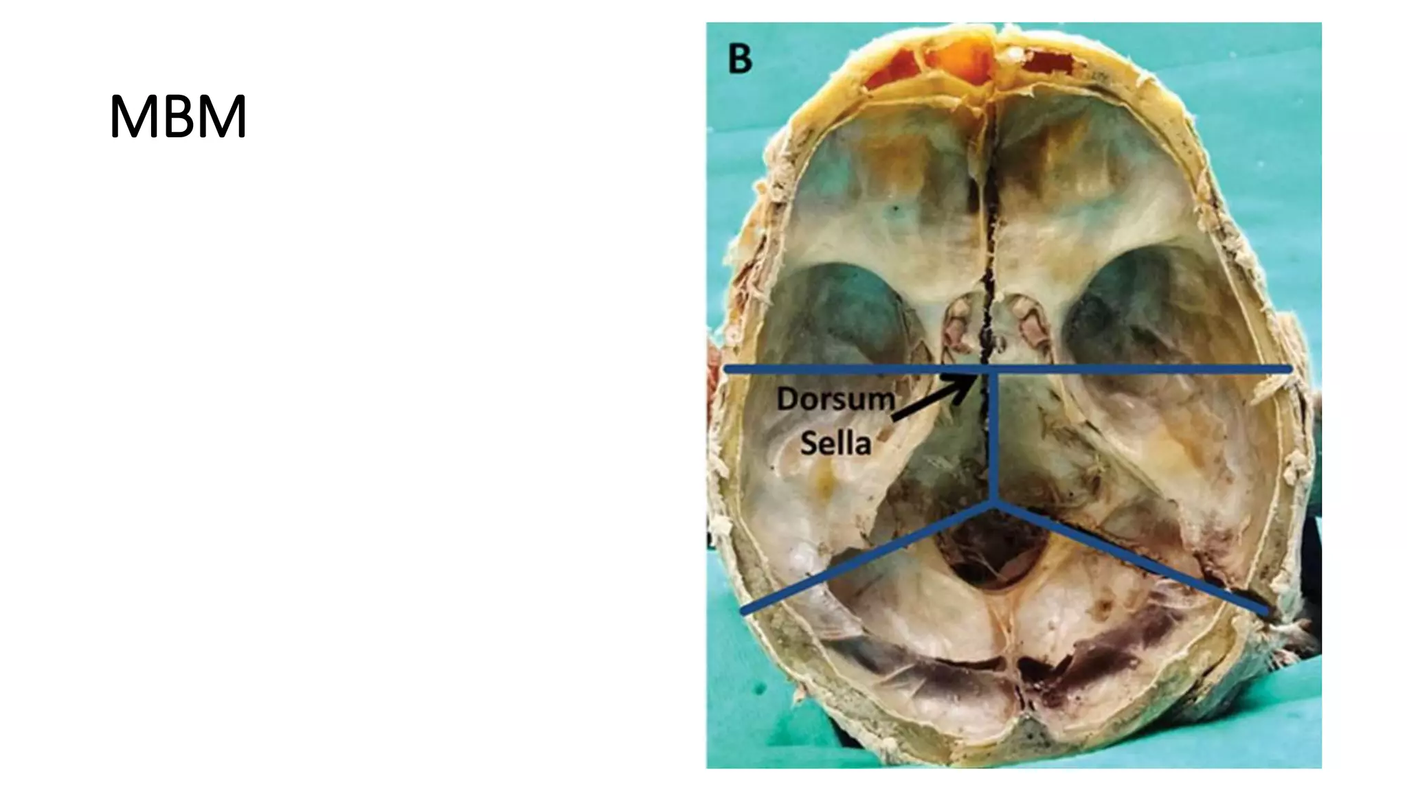 Temporal bone dissection | PPTX