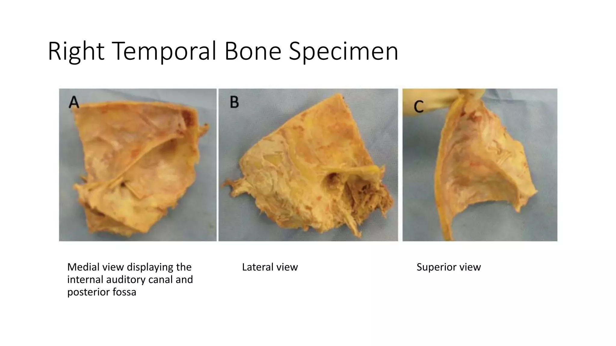 Temporal bone dissection | PPTX