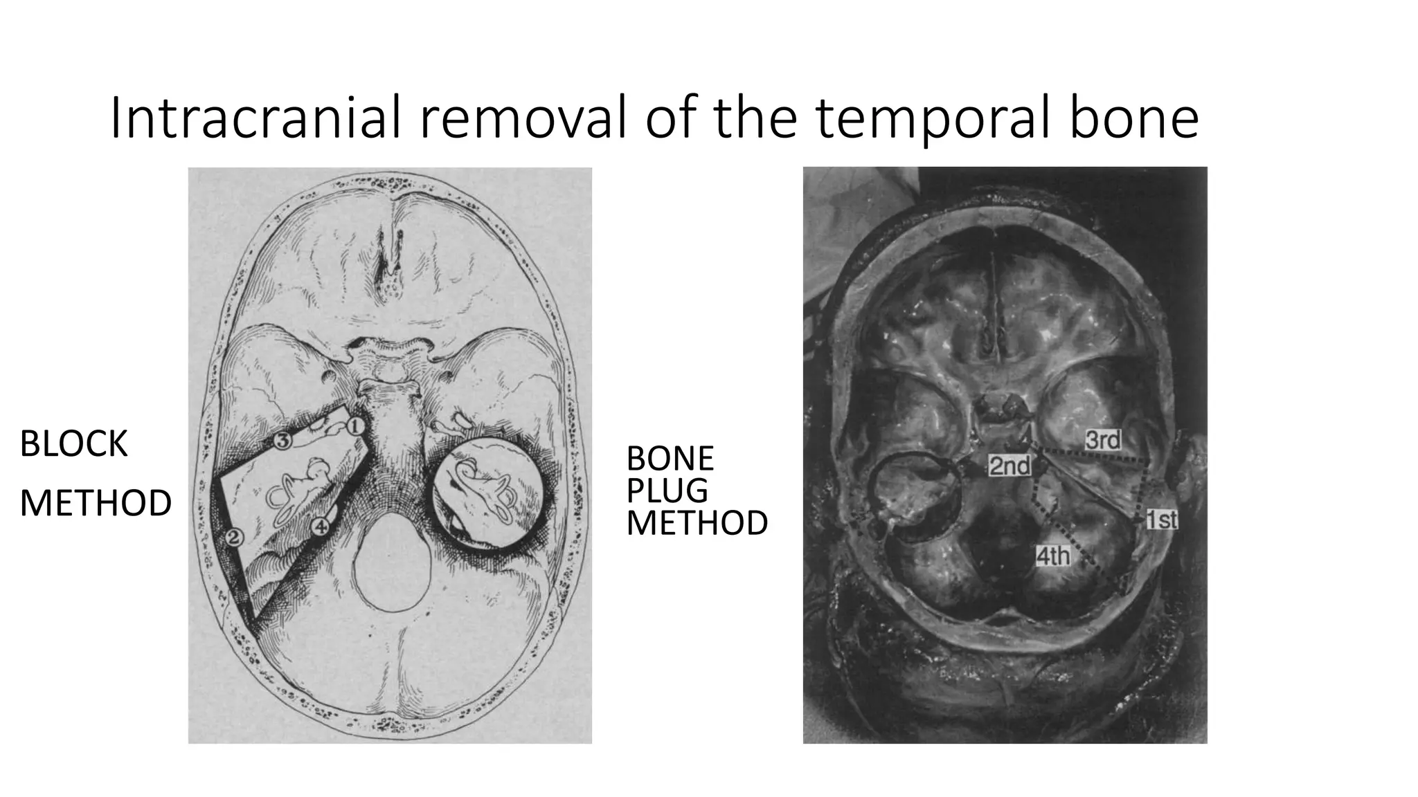 Temporal bone dissection | PPTX