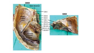 Temporal bone dissection | PPTX