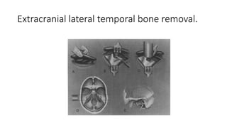 Temporal bone dissection | PPTX