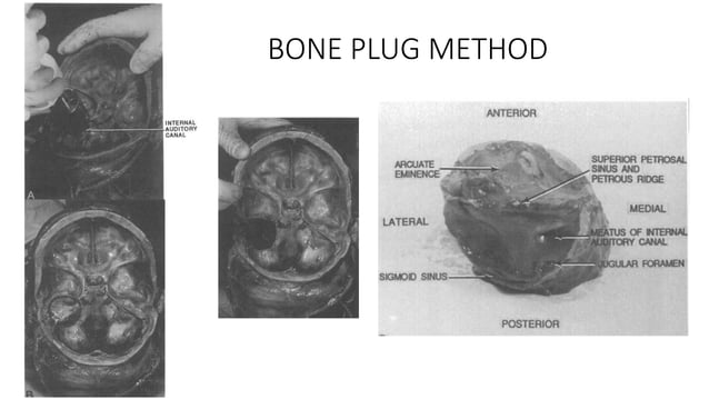 Temporal bone dissection | PPTX | Death, Injury, or Military Conflict | Sensitive Topics