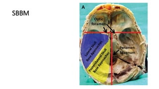 Temporal bone dissection | PPTX