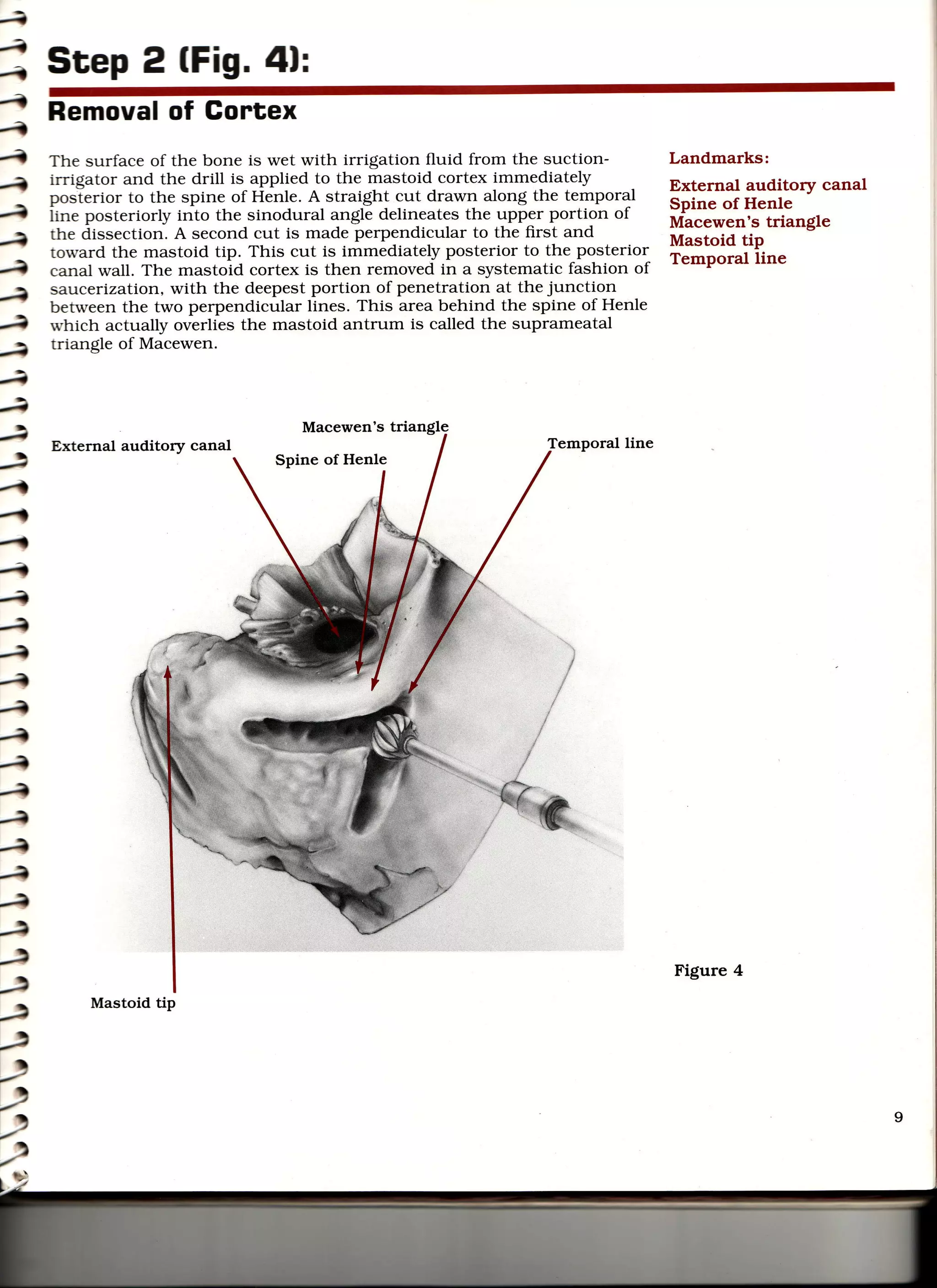 Temporal bone dissection (house) | PDF