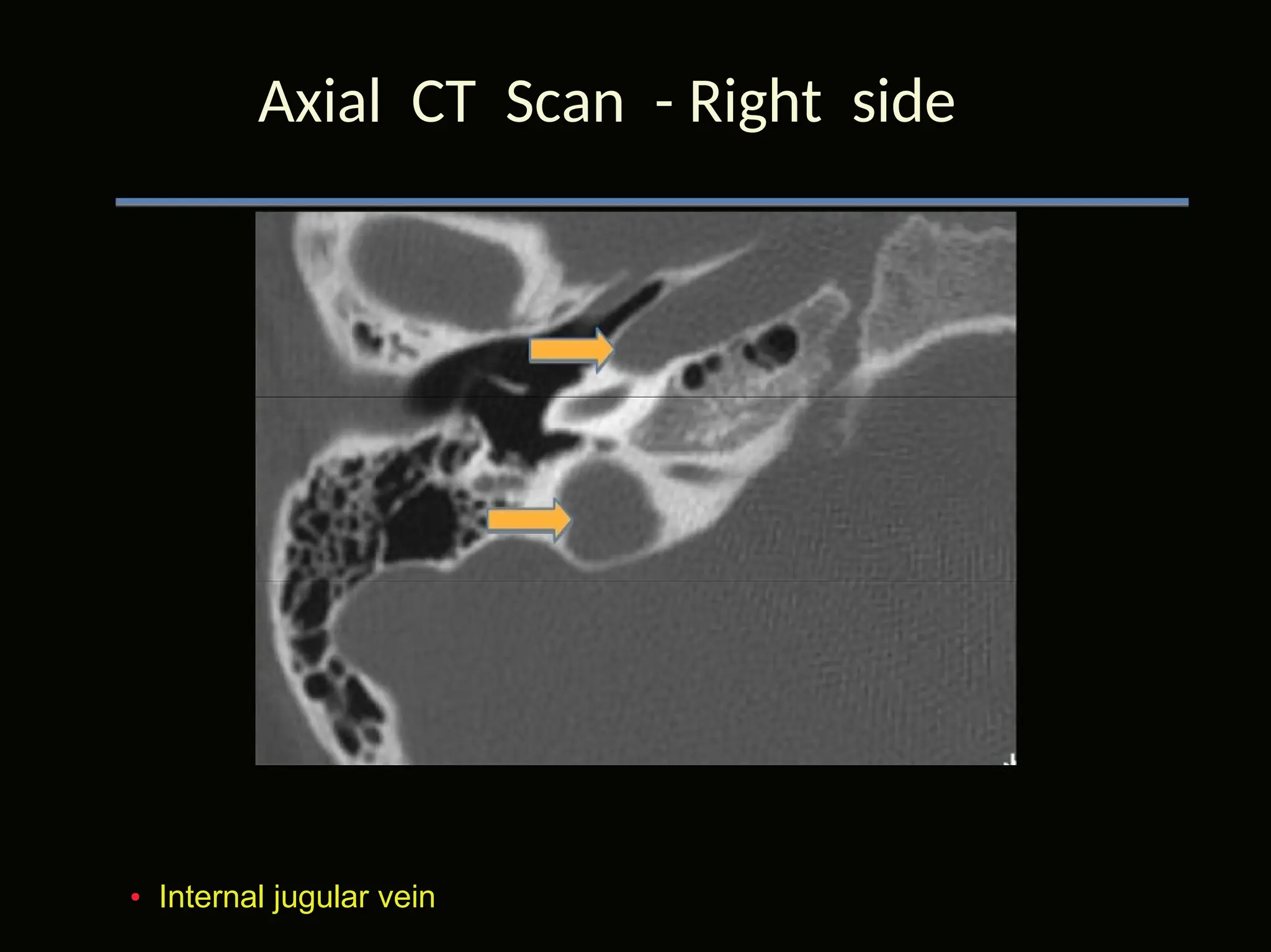 Temporal bone HRCT anatomy.ppt this ppt provides a comprehensive study into temporal bone ...