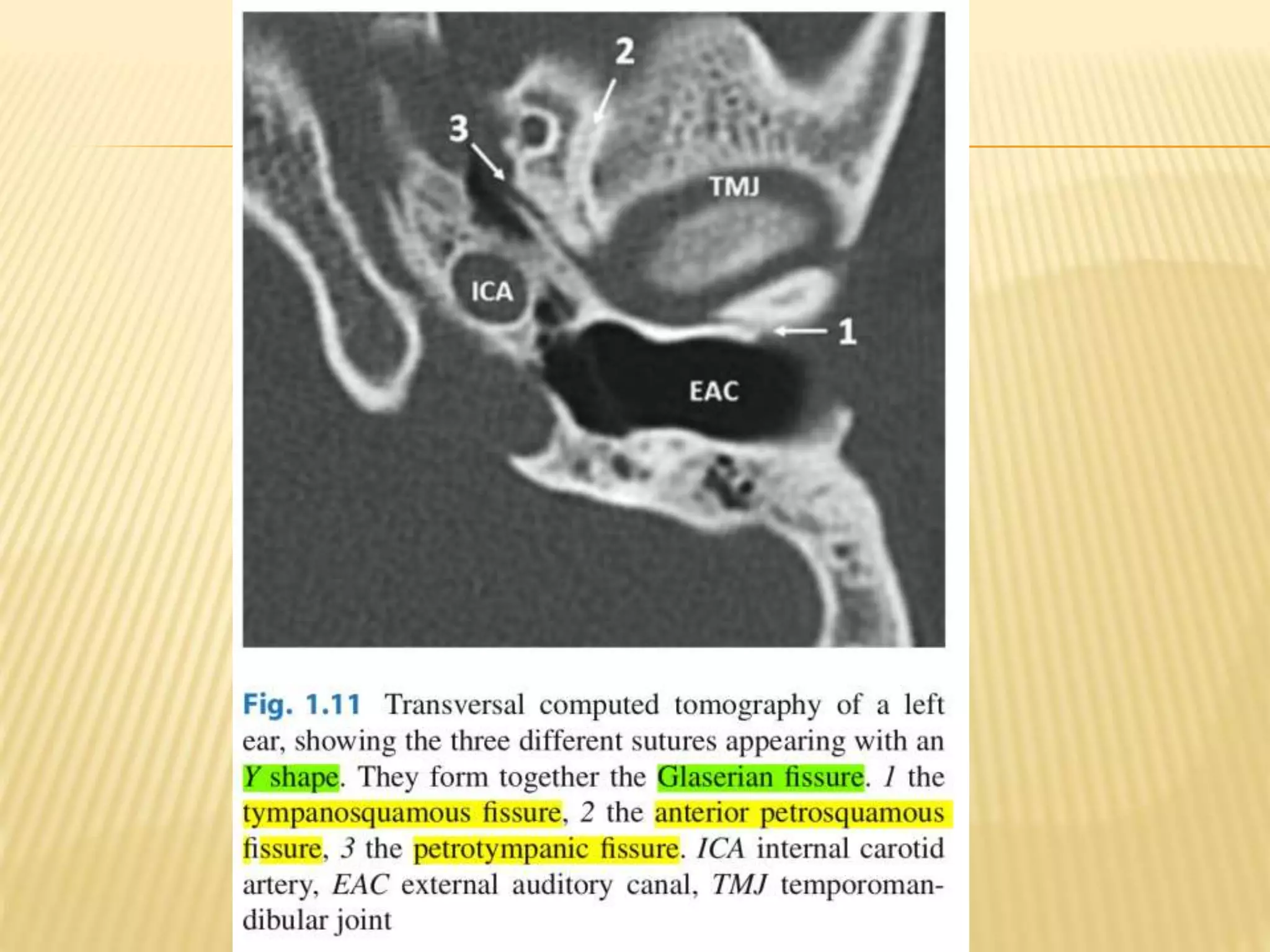 Temporal bone & Mastoid anatomy - Arjun Antony Graison | PPTX