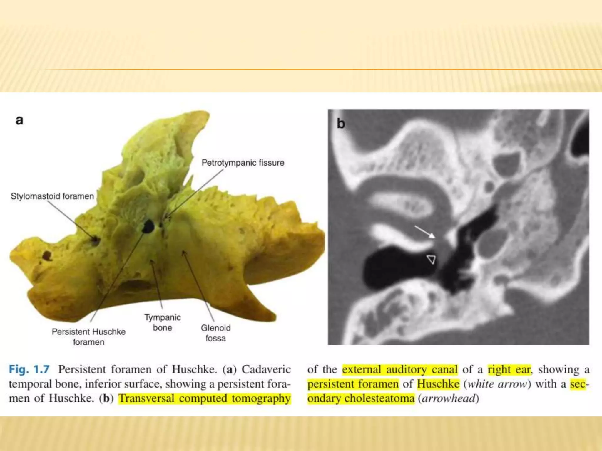 Temporal bone & Mastoid anatomy - Arjun Antony Graison | PPT