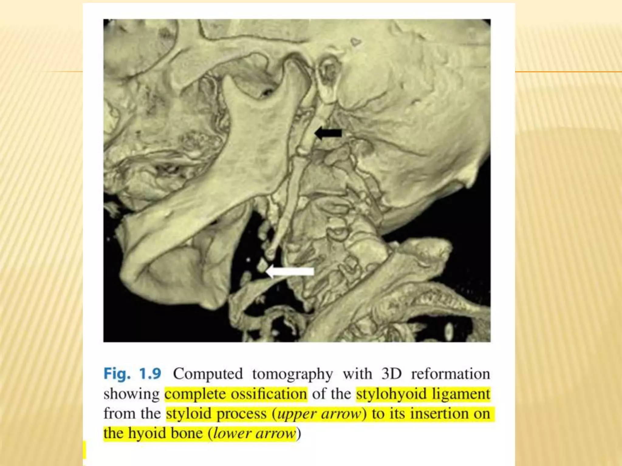 Temporal bone & Mastoid anatomy - Arjun Antony Graison | PPTX