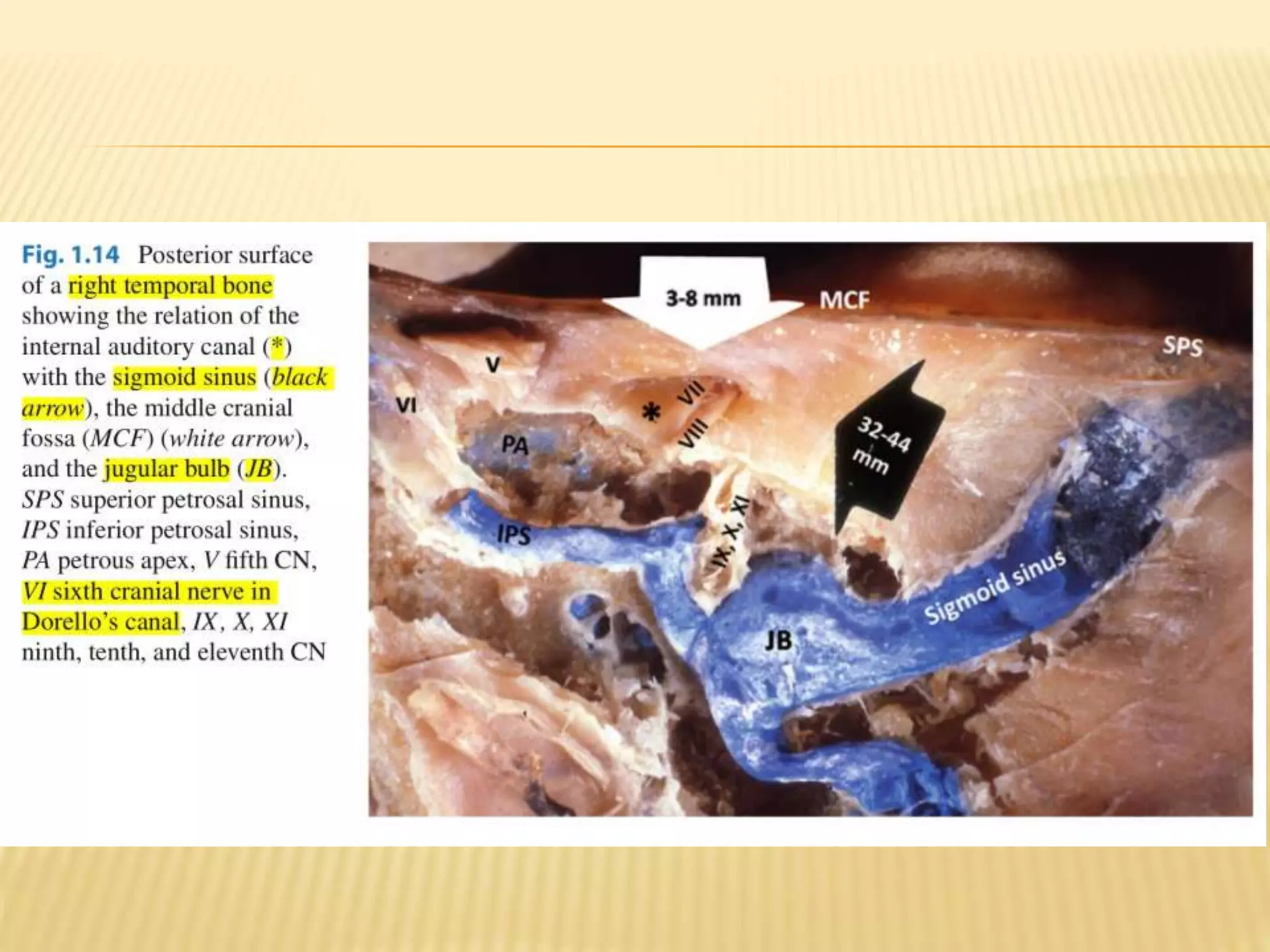 Temporal bone & Mastoid anatomy - Arjun Antony Graison | PPTX