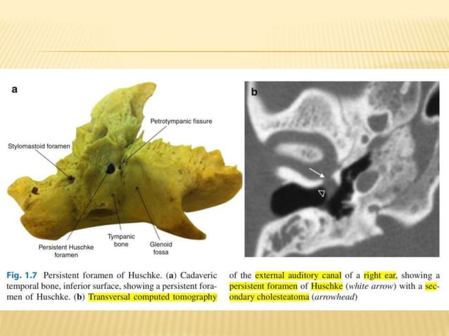 Temporal bone & Mastoid anatomy - Arjun Antony Graison | PPTX