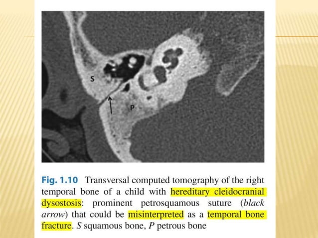 Temporal bone & Mastoid anatomy - Arjun Antony Graison | PPTX