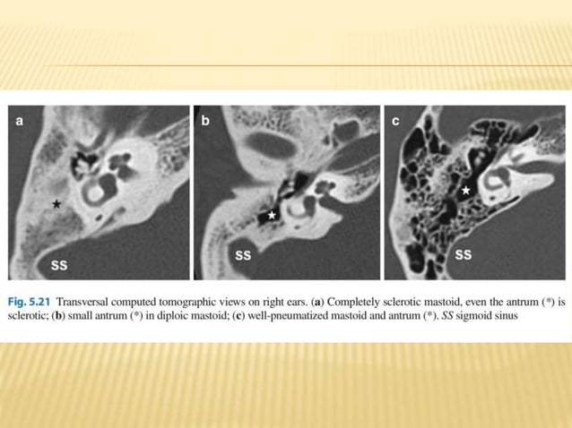 Temporal bone & Mastoid anatomy - Arjun Antony Graison | PPTX