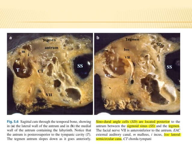 Temporal bone & Mastoid anatomy - Arjun Antony Graison | PPT