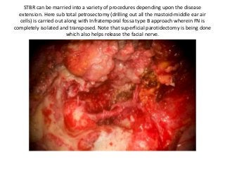 Temporal bone resection | PPTX