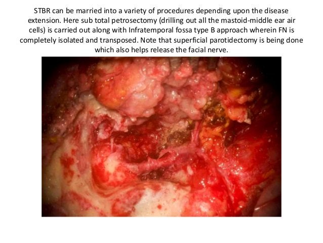 Temporal bone resection | PPT