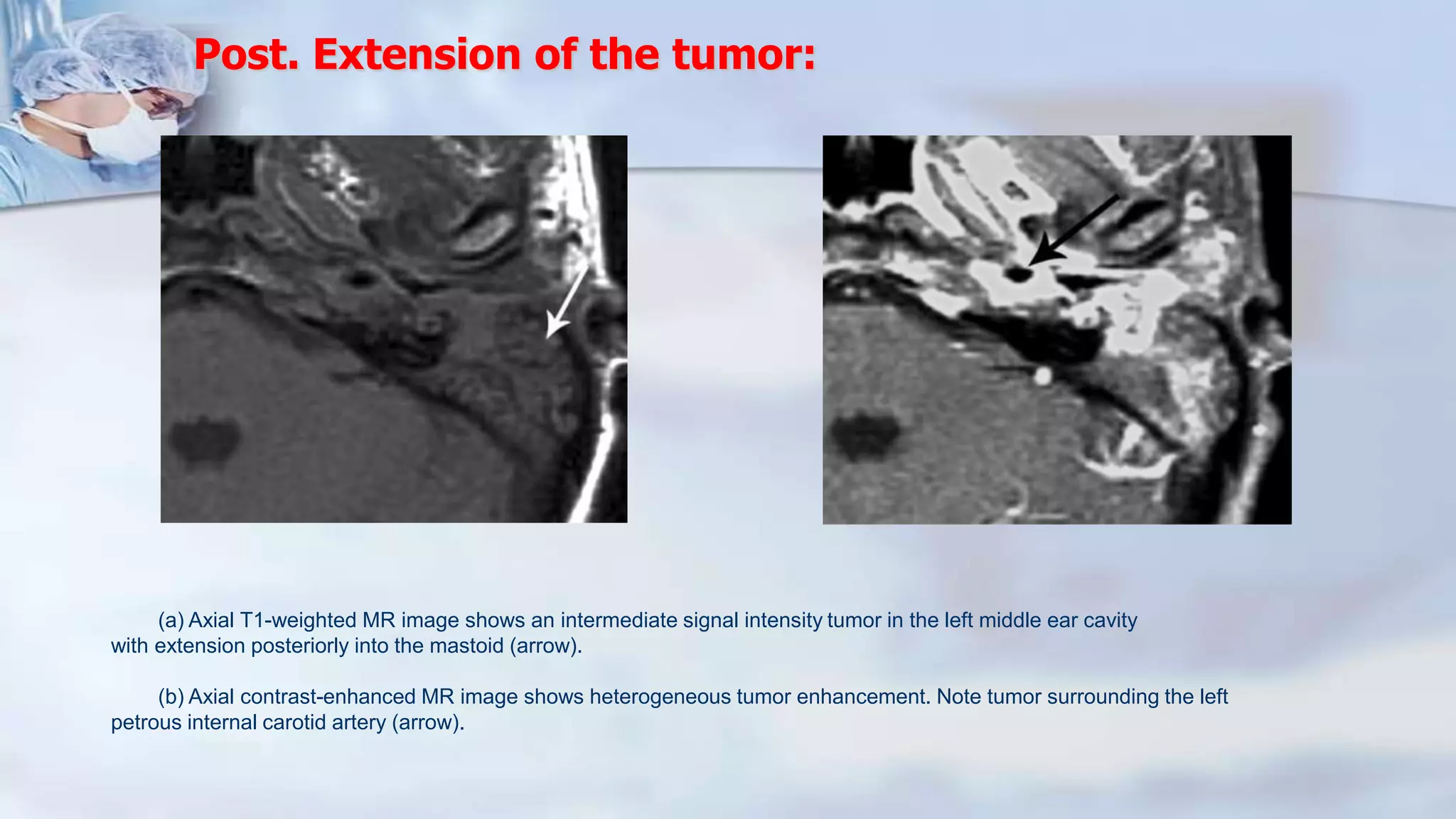 Temporal bone tumors staging and radiological assesment | PPTX