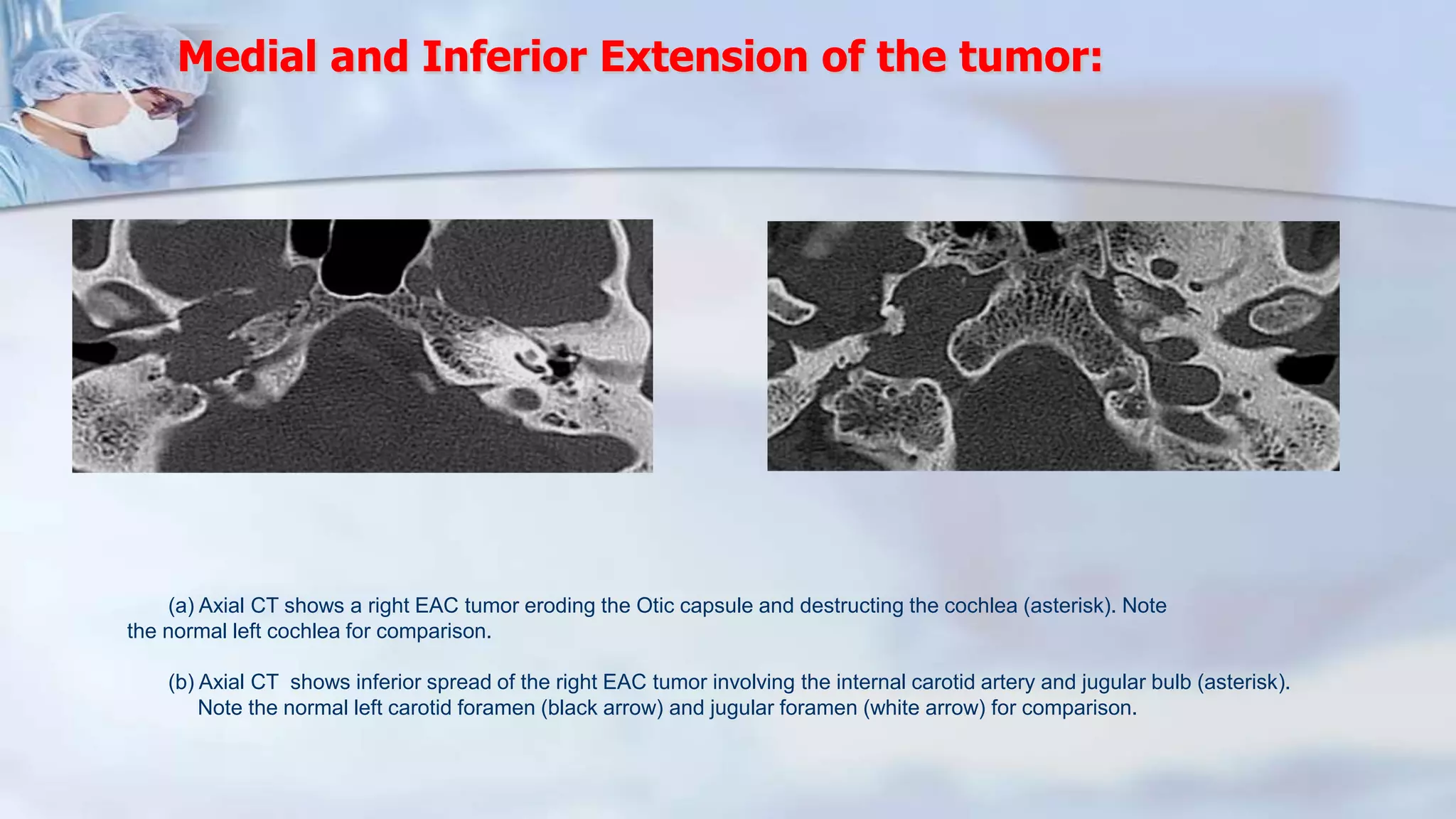 Temporal bone tumors staging and radiological assesment | PPTX