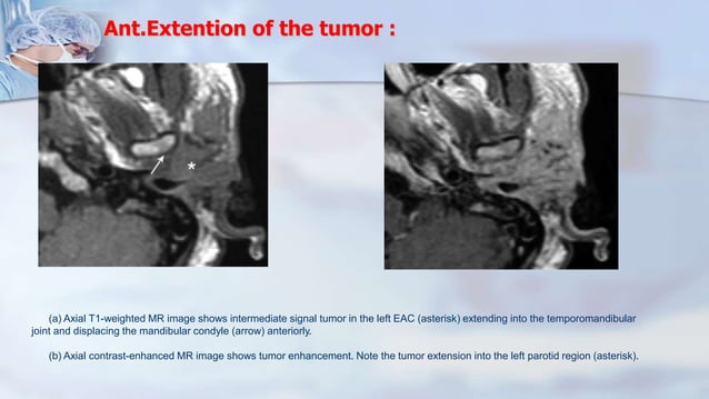 Temporal bone tumors staging and radiological assesment | PPTX | Ear ...