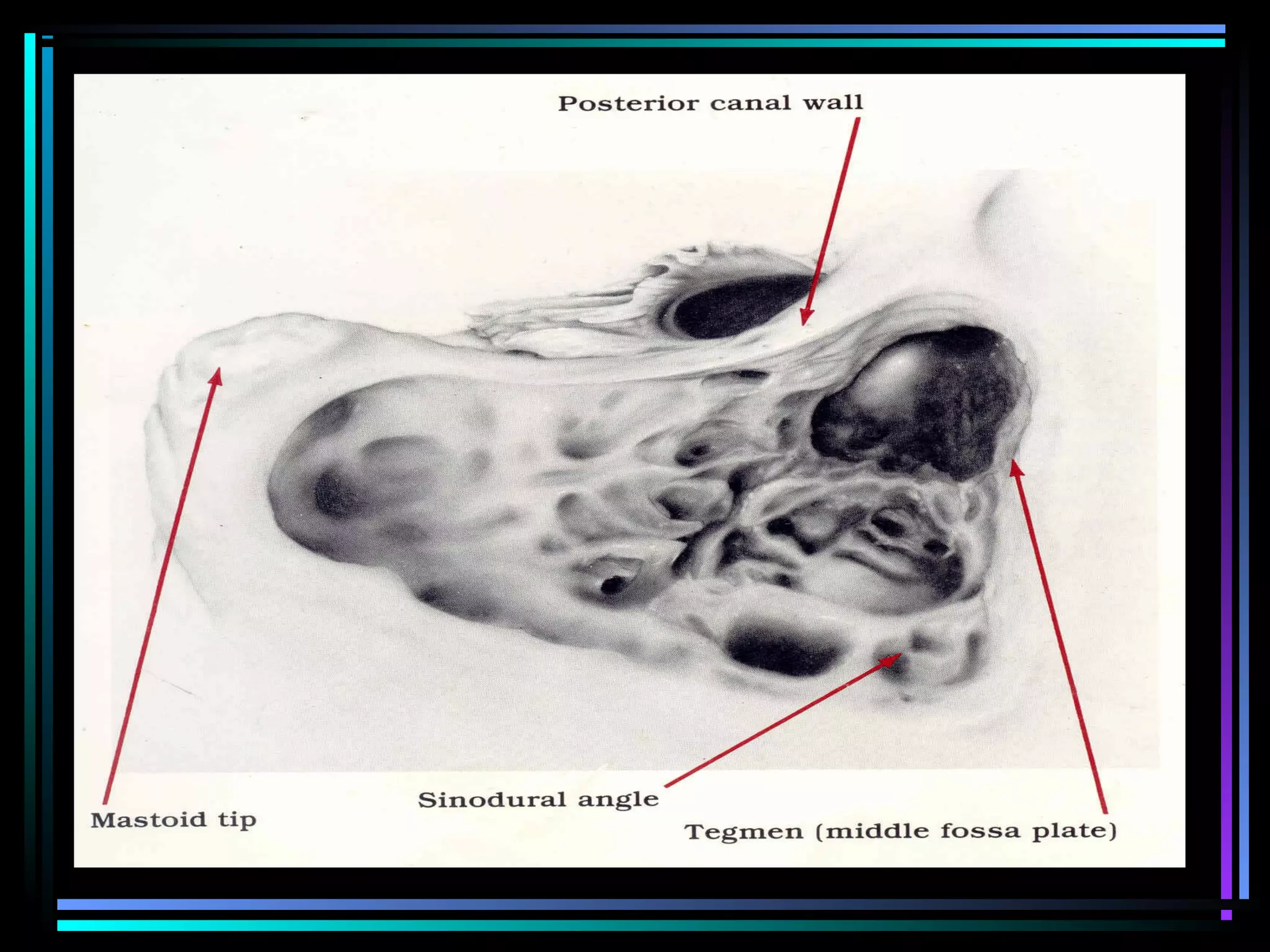 Temporal dissection | PPT