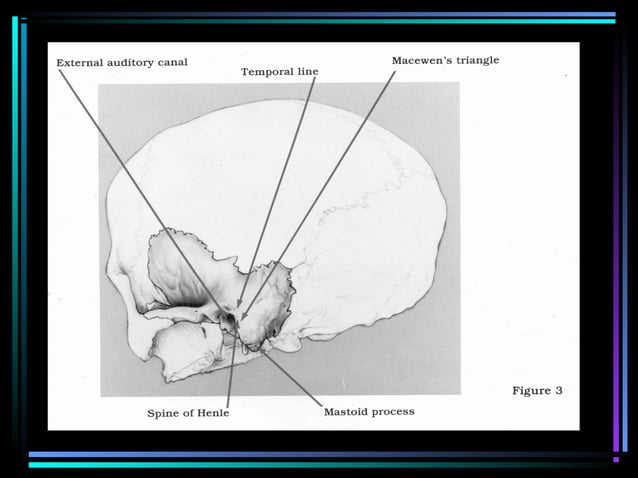 Temporal dissection | PPT