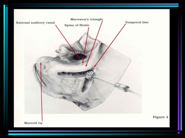 Temporal dissection | PPT