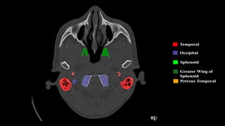 Temporal Bone Imaging | PDF