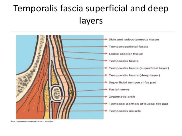 temporoparietal flaps