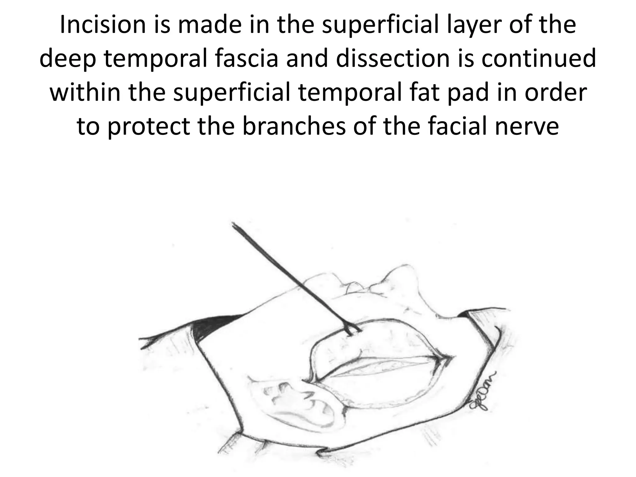Temporalis muscle flap | PPTX