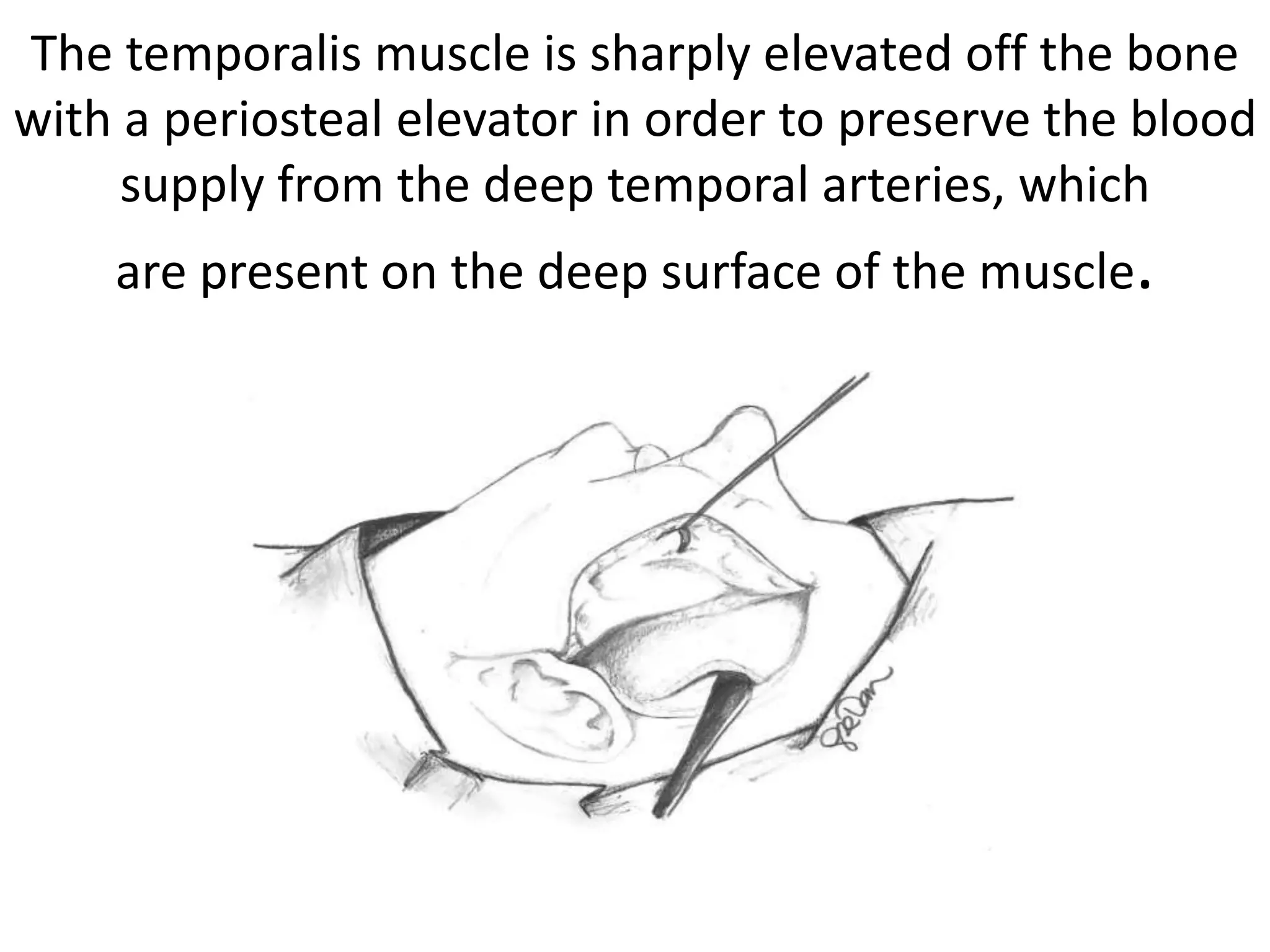 Temporalis muscle flap | PPTX