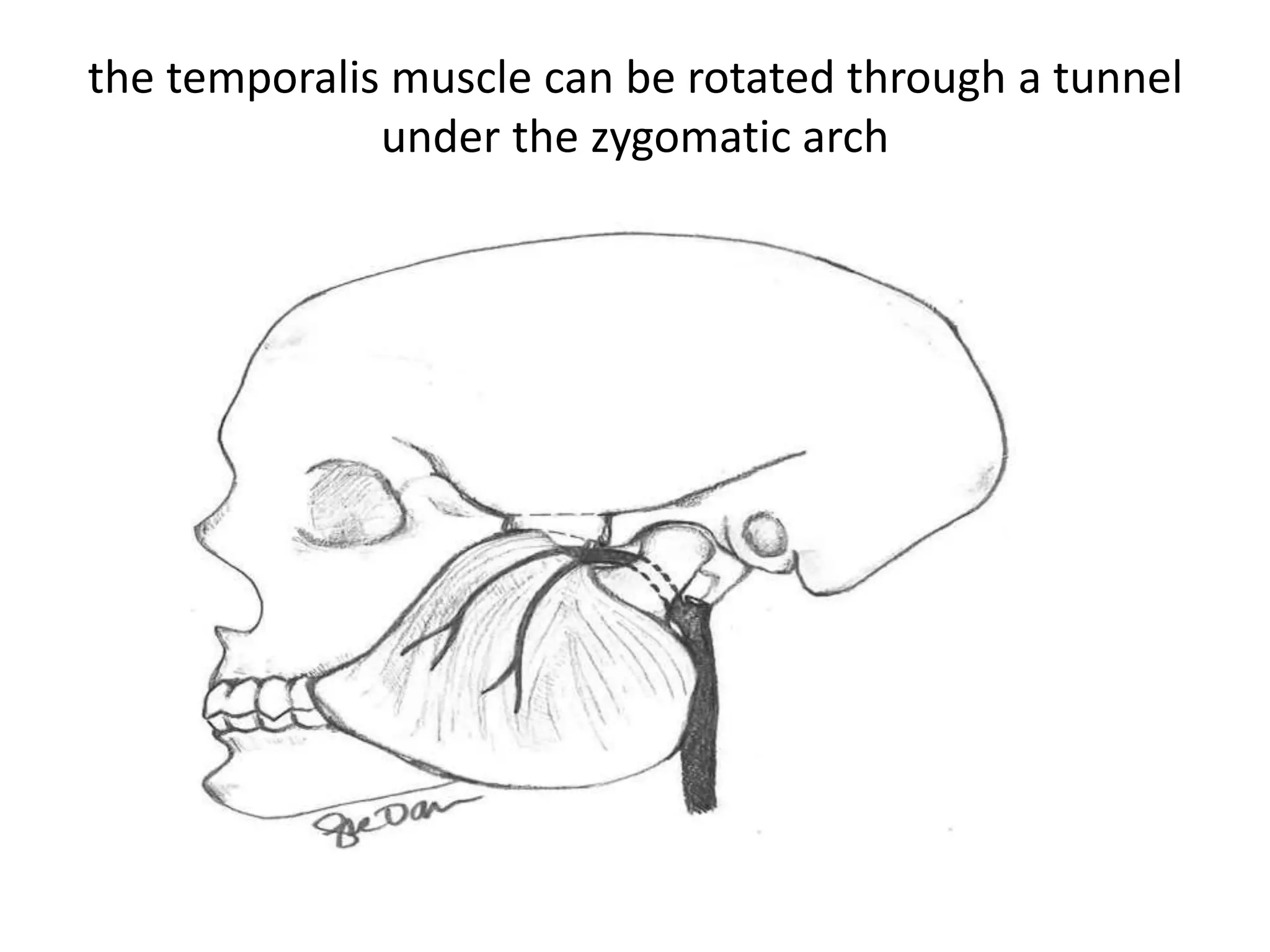 Temporalis muscle flap | PPTX